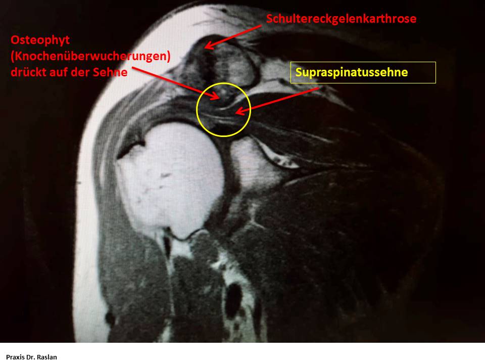 Icd 10 Ac Gelenk | ICD-10-GM-2025: gelenks arthrose – DNAGIX