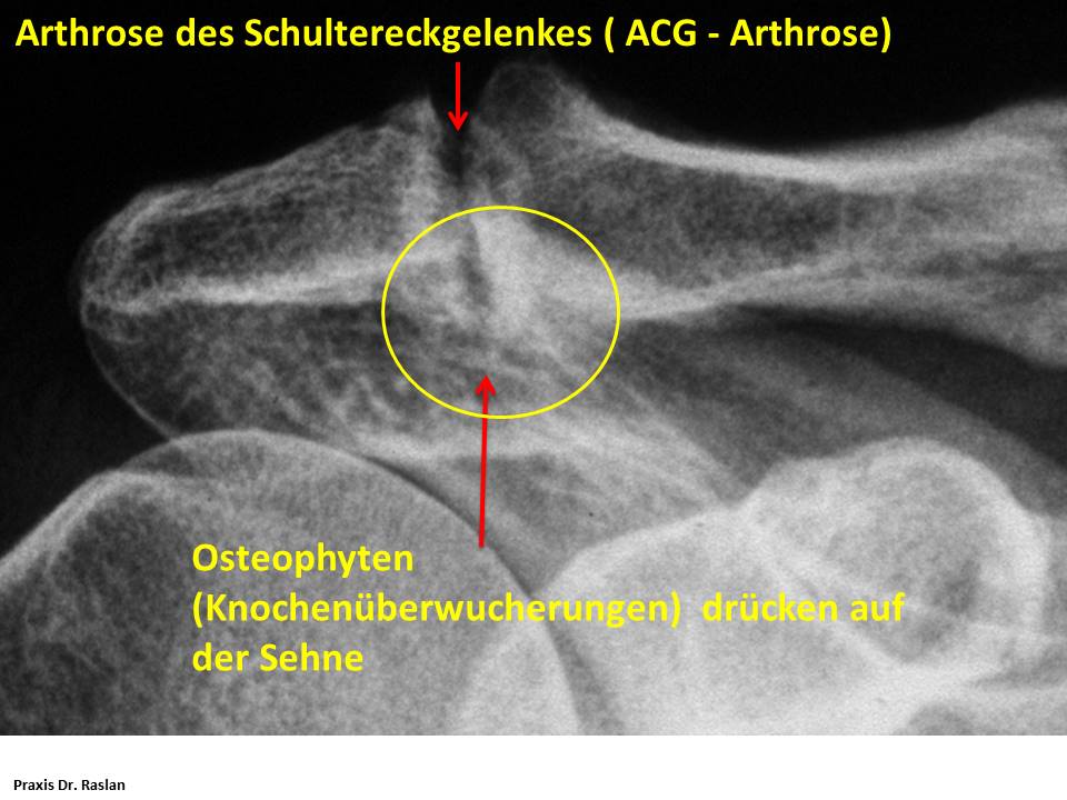 Icd 10 Ac Gelenksarthrose : Acromioclaviculargelenksarthrose – LZGCIJ